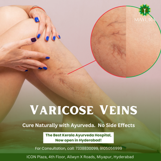 Understanding Varicose Veins: Causes, Symptoms, and Treatment - Mayura Hospitals