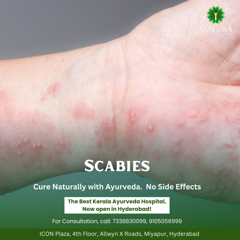 Understanding Scabies: Causes, Symptoms, and Effective Treatments - Mayura Hospitals